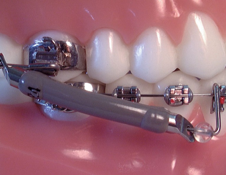Fixed & Functional | American Orthodontics