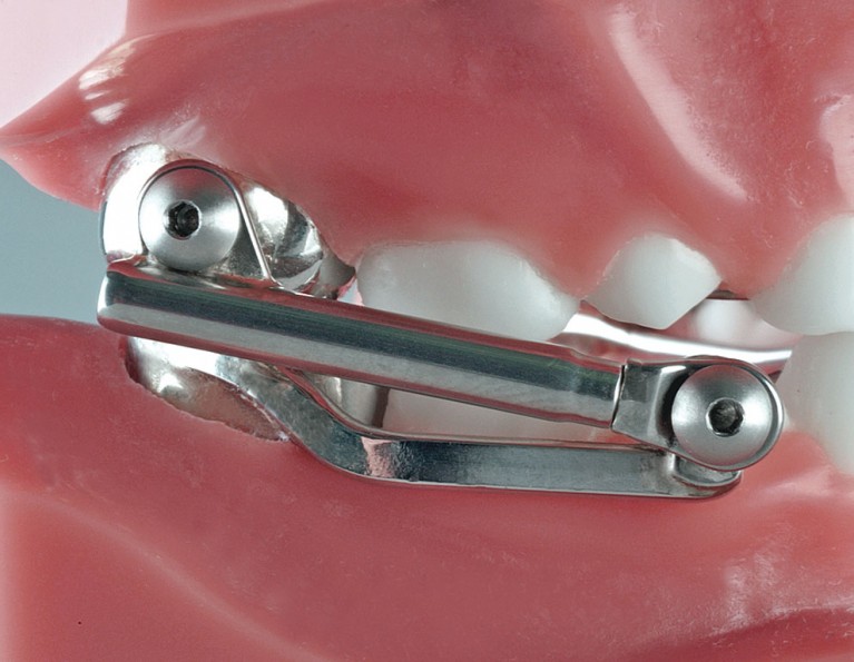 Fixed And Functional American Orthodontics 